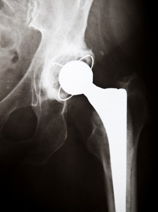 HSE to order review of all metal-on-metal hip replacement devices